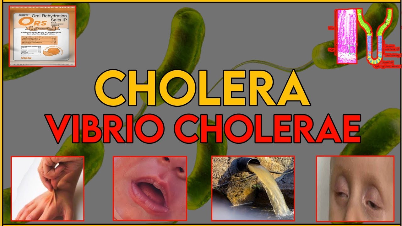 Cholera(vibrio cholerae),pathophysiology, clinical finding,diagnosis ...
