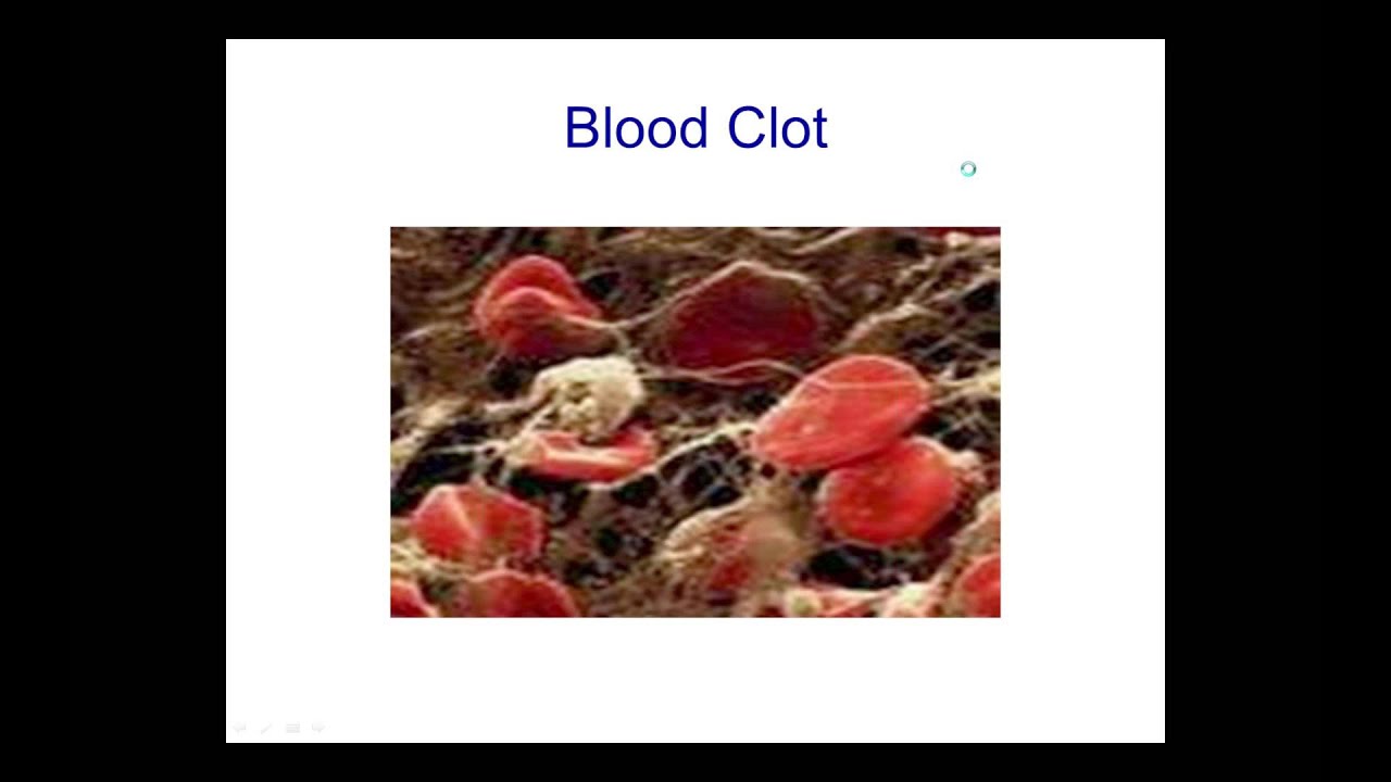 Understanding the term (coagulopathy) in vascular anomalies - YouTube