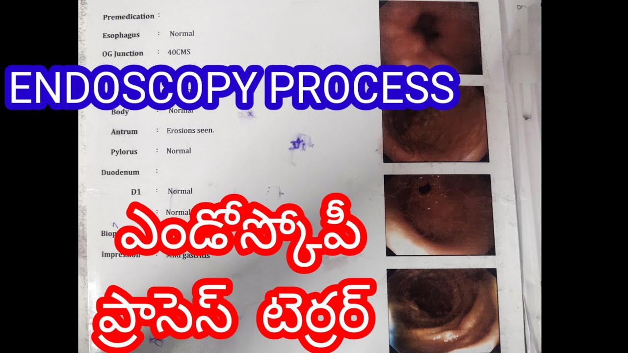 Endocopy Procedure To An Women | And The Women Experience | Women ...