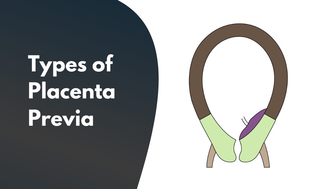 Placenta Previa Types