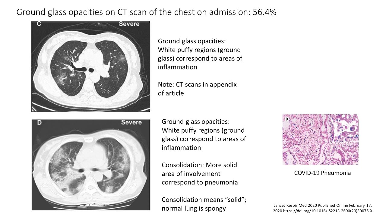 COVID-19 Clinical Characteristics with Radiology 6 min - YouTube