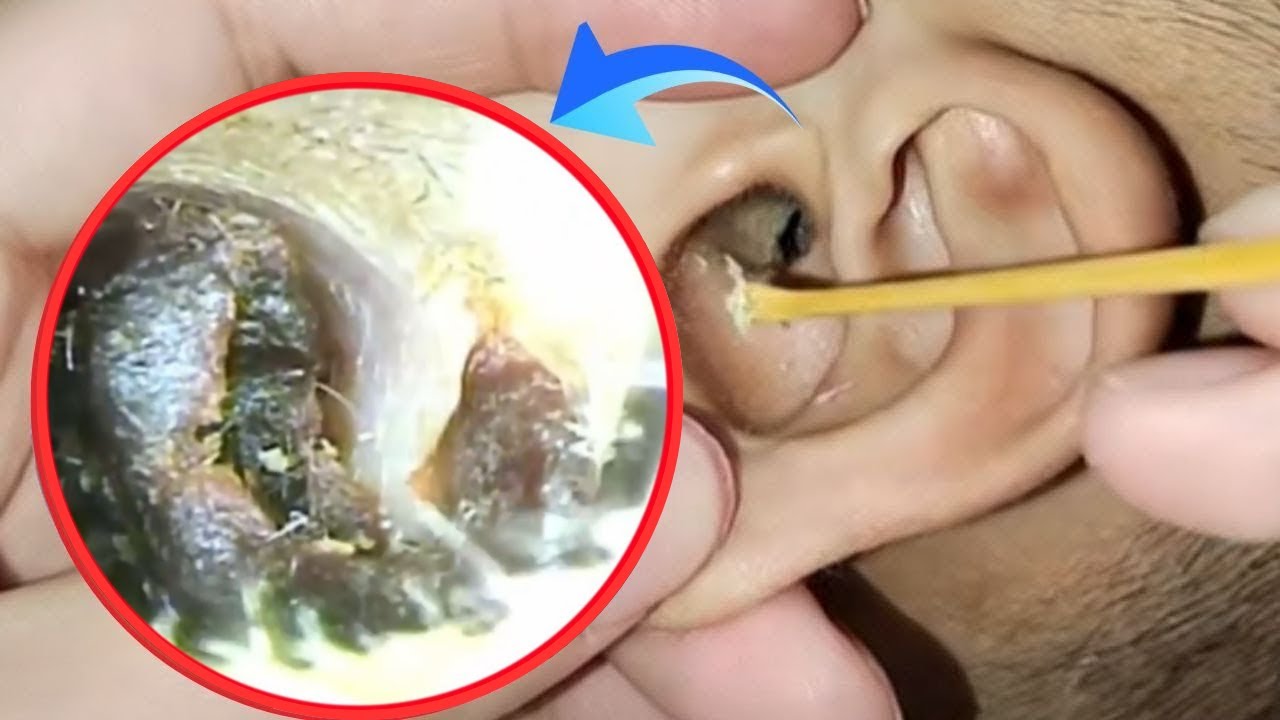Horror Earwax Removal 😱 | Gross Infected Ear Cleaning ASMR | EP 96 ...