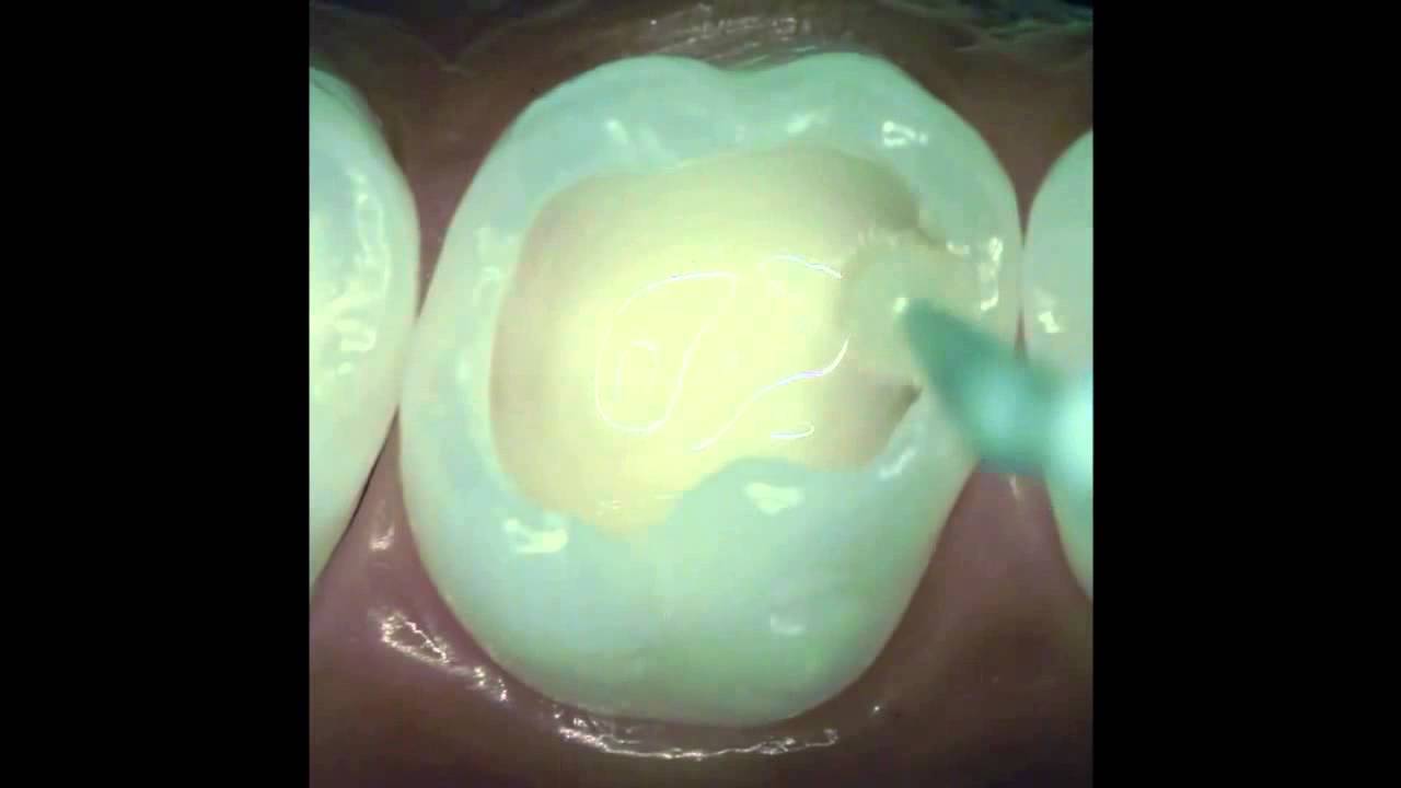 Xeno Select - Guia ilustrada técnica - YouTube