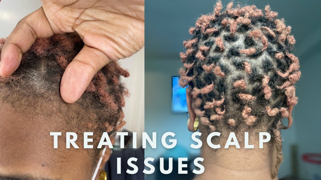 Hair Update: Flakes, scabs, & a solution | Brittany's Room - YouTube