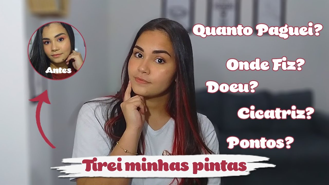 REMOÇÃO DE PINTAS - REMOVI 5 PINTAS COM CIRURGIA - YouTube