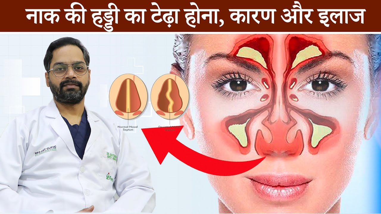 बिना सर्जरी, नाक की टेढ़ी हड्डी का इलाज | naak ki haddi badhna ka ilaj ...