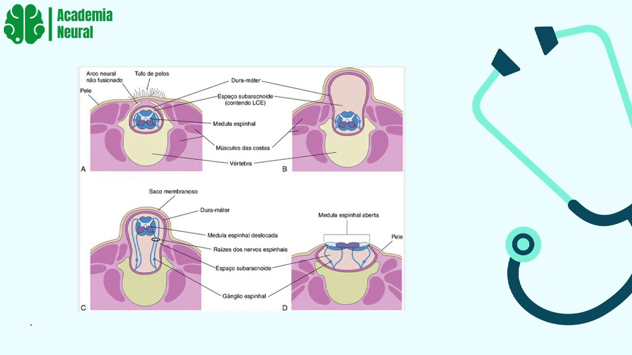 Aula 1 Neuro Embriologia Clínica - Defeitos na Formação do Tubo Neural ...