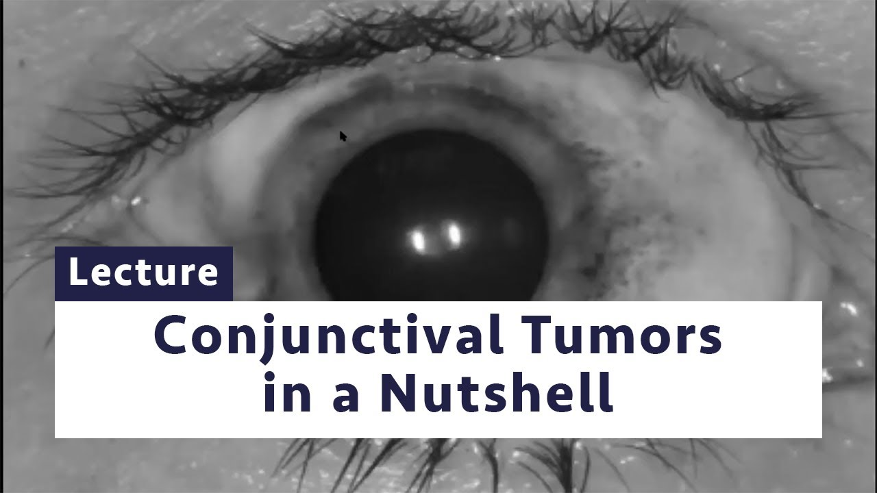 Conjunctival tumors in a nutshell - YouTube
