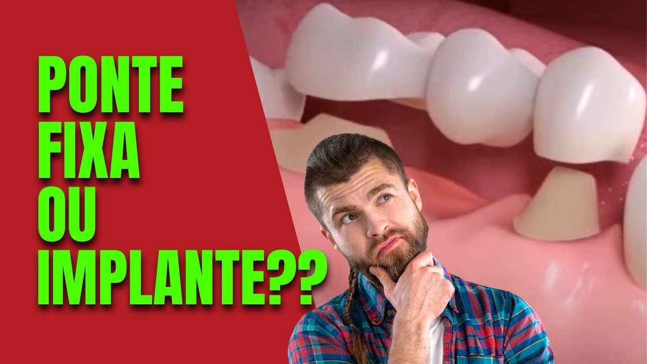 Implantes dentais ou ponte fixa sobre dentes? O que é melhor? - YouTube