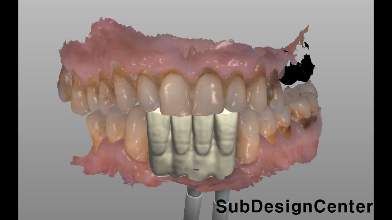 3shape design (anterio teeth, lower,implant) // 3shape 디자인 하악 전치부 임플란트 ...