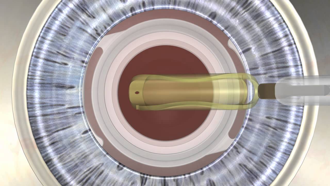 The Harmoni Lens: Modular IOL - YouTube