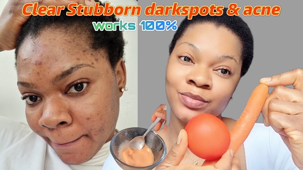 How to remove Stubborn dark spots, acne &pimples..look YOUNGER # ...