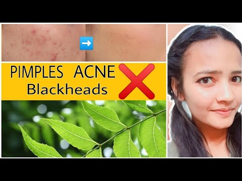 Disprin Tablet For Skin | Pigmentation | Blackheads/Acne/Pimples ...