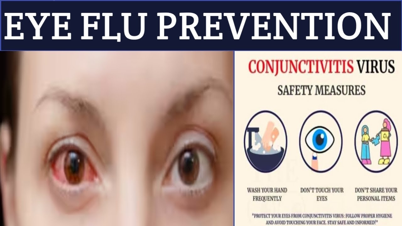 How to take prevention from eye flu ll it's symptoms and treatment ...