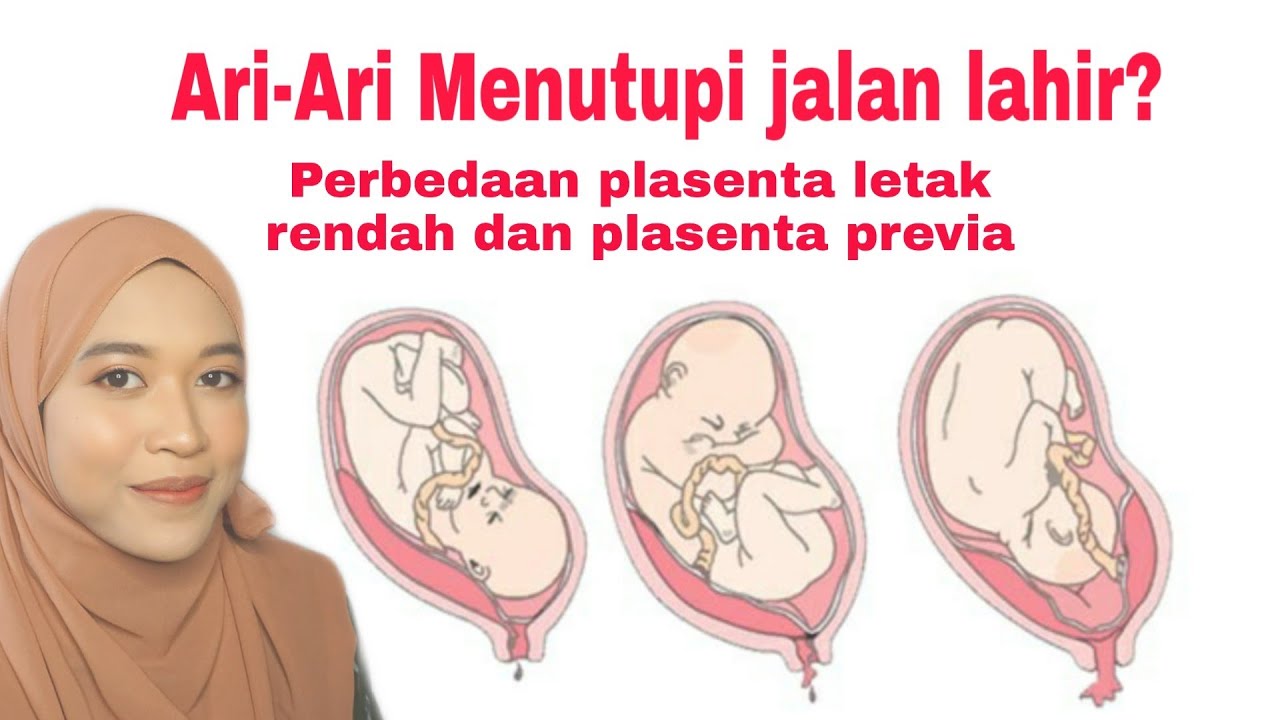 Plasenta letak rendah bisa melahirkan secara normal? - YouTube