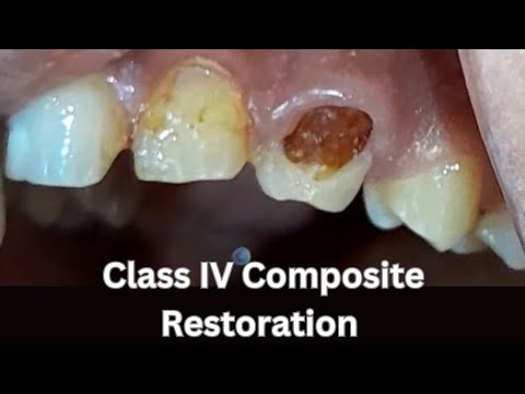 Class IV composite restoration (operative dentistry) #dentalesthetics # ...