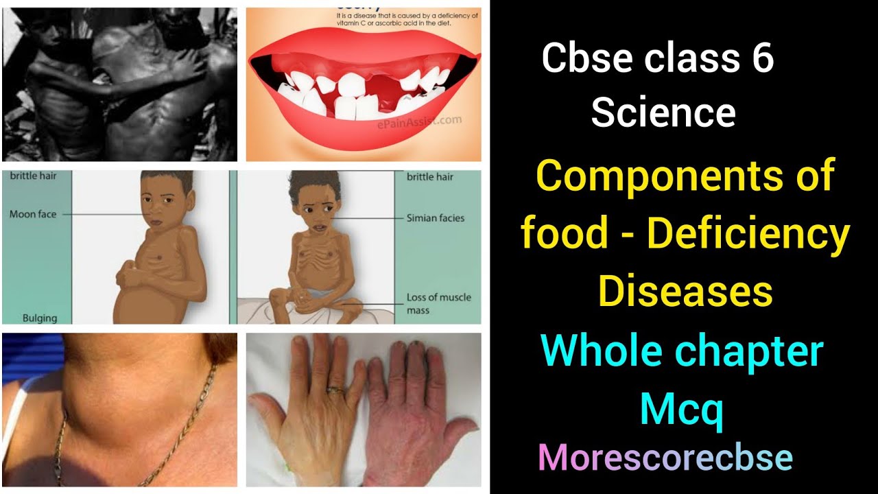 Cbse class 6 | Science | Chapter 2 | Deficiency diseases | MCQ | #cbse ...
