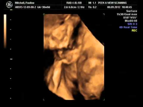Bumps 30 week 3D scan part3 - YouTube