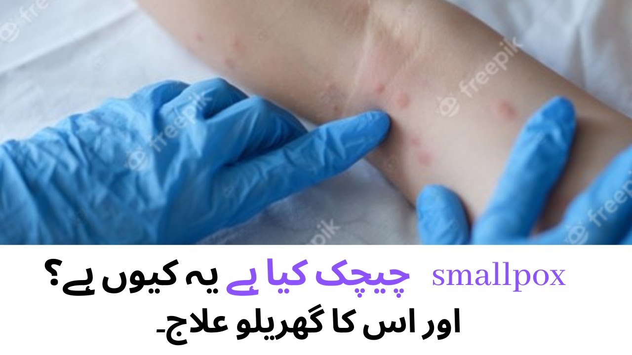 What is smallpox and why is it?And its home remedies.FACE PER DANEY ...