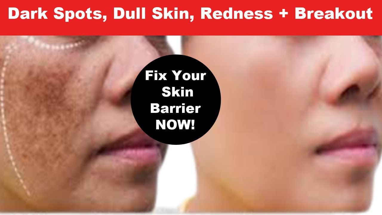 Fix Your Skin Barrier Now! The Best Routine for Redness, Dark Spots ...