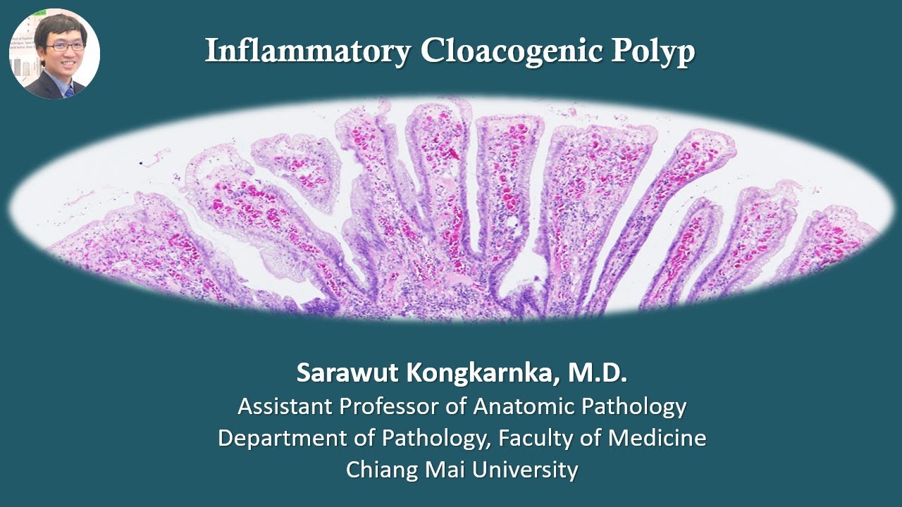 Inflammatory Cloacogenic Polyp - YouTube
