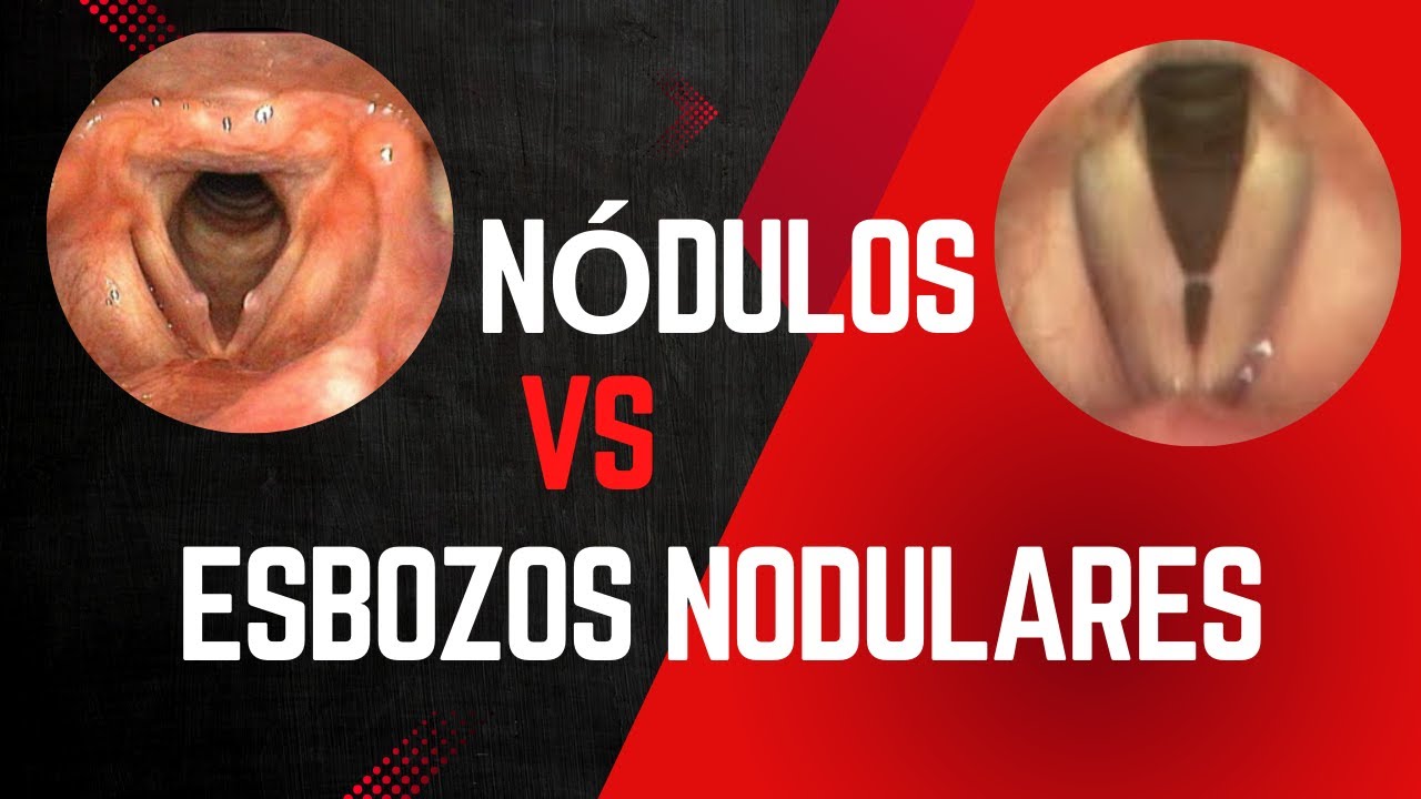 Nódulos y Esbozos nodulares ¿SON LO MISMO? - YouTube