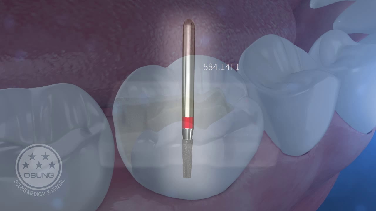 Inlay restoration - YouTube