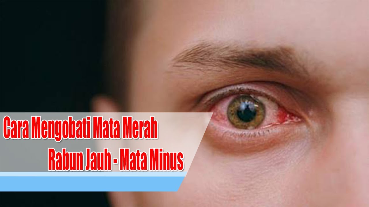 Apakah Mata Minus & Mata Rabun Bisa Sembuh ?? - YouTube