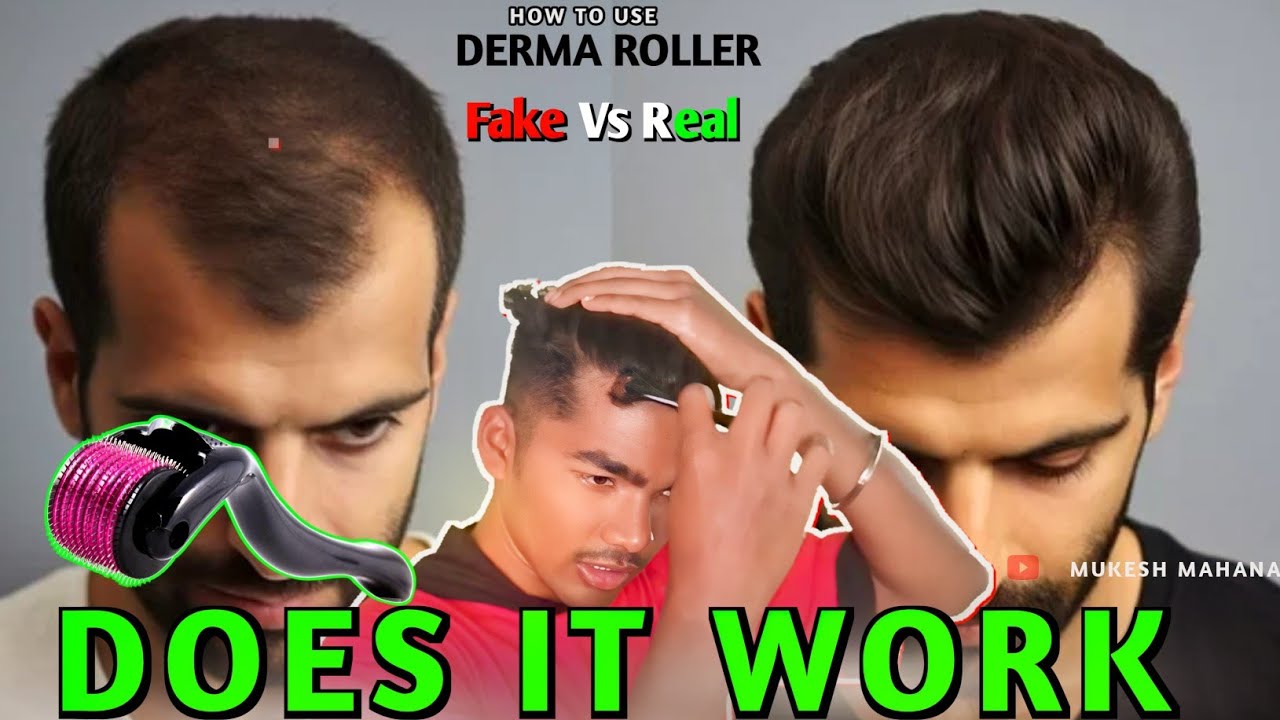 How To Use Derma Roller For Hair Loss || Review || Real Vs Fake - YouTube