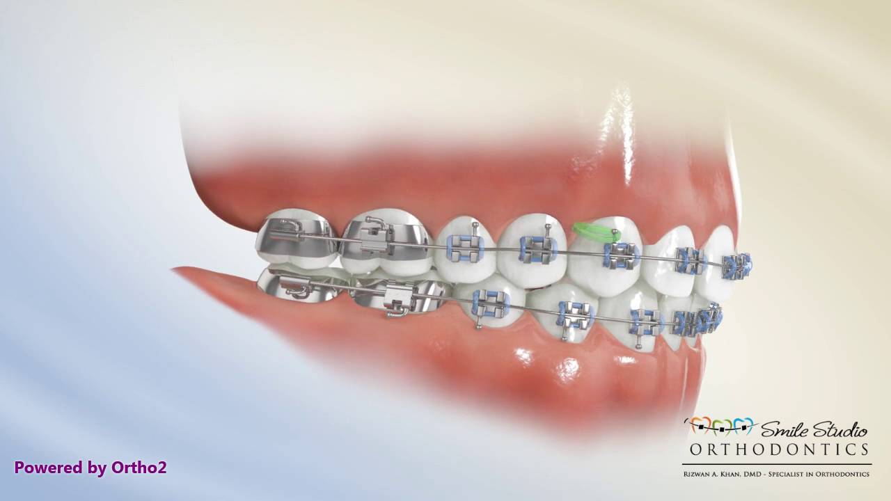 Elastics Class Iii Box Orthodontic Treatment Youtube