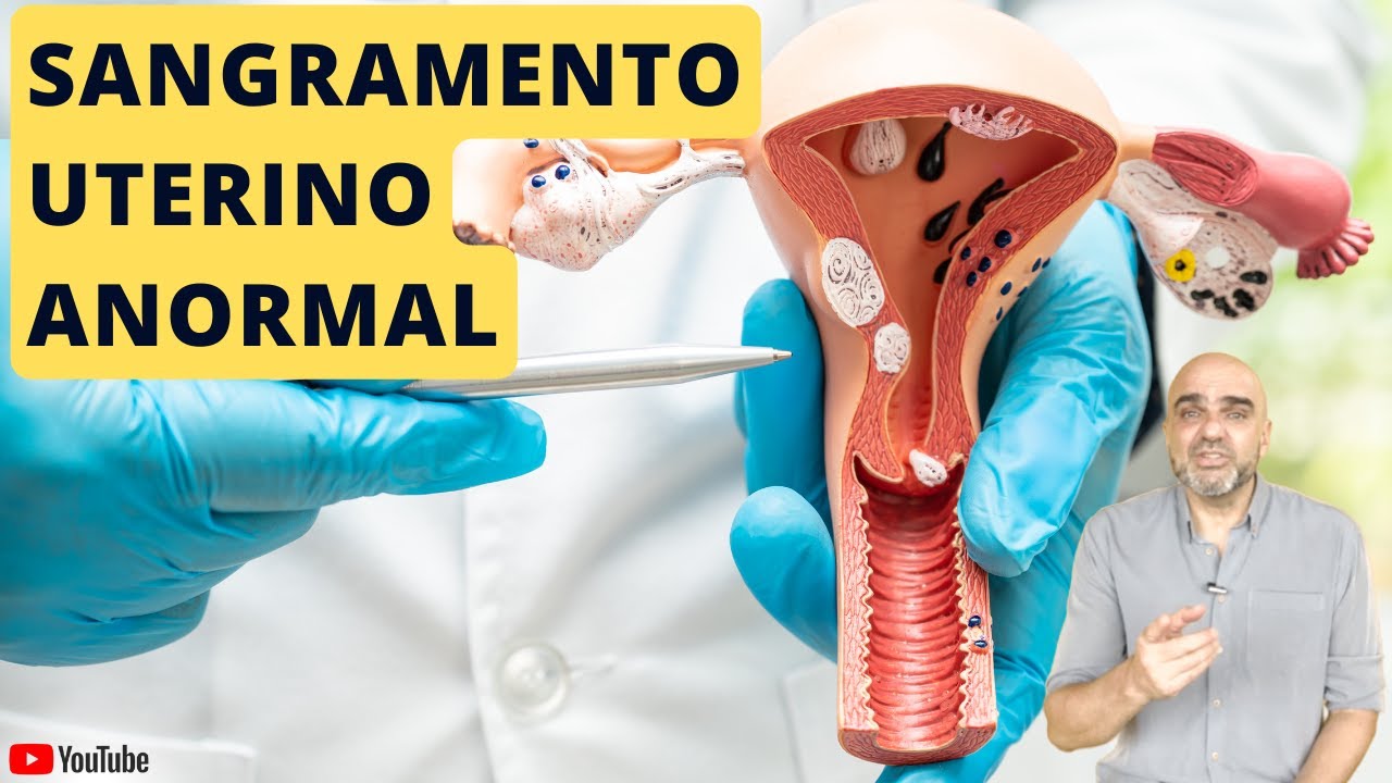 O que é e quais as principais causas do SANGRAMENTO UTERINO ANORMAL ...