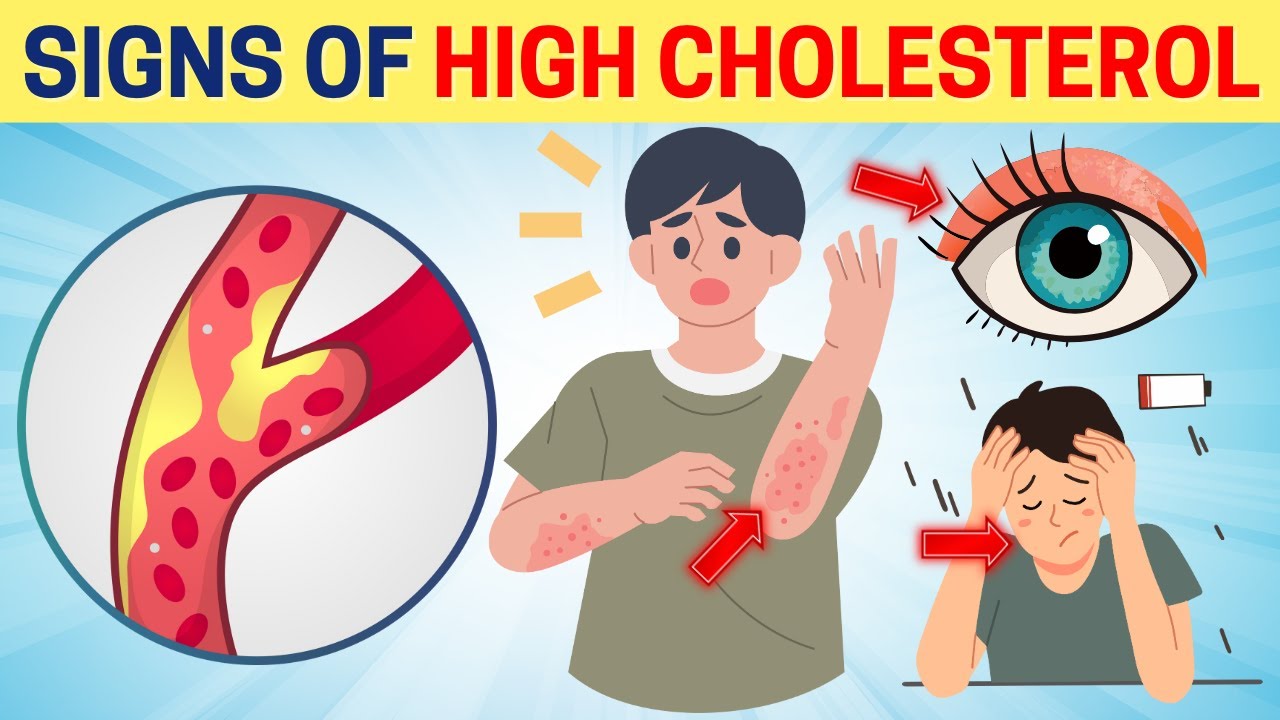 12 Warning Signs Your Cholesterol Is Dangerously High - YouTube