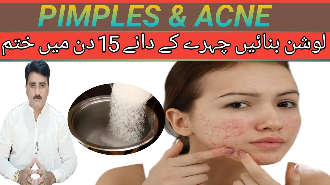 چہرے کے دانے Pimples and Acne سے جان چھڑانے کیلئے لوشن بنائیں/chehre Ke ...