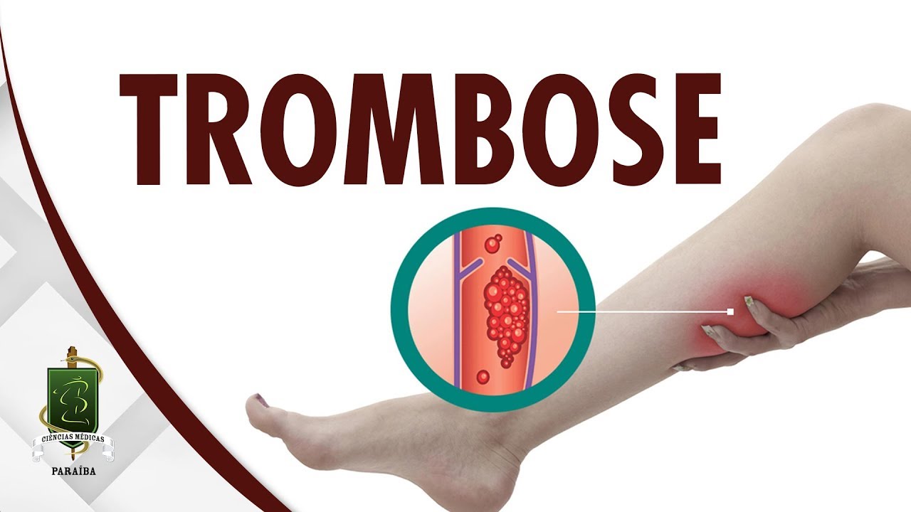 Trombose - YouTube