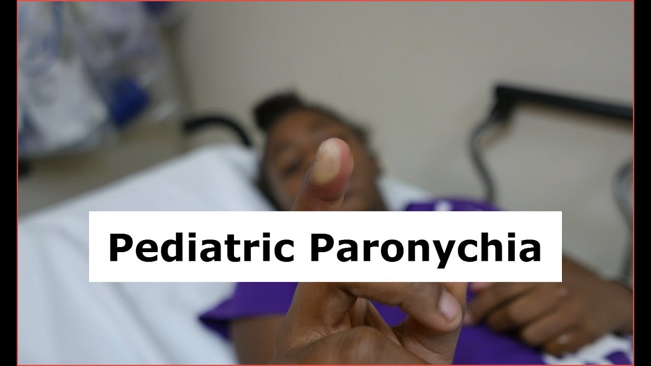 Pediatric Paronychia Drainage - YouTube