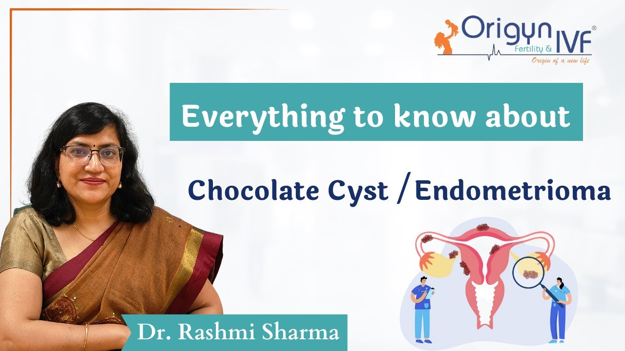 Everything to know about Chocolate Cyst / Endometrioma - YouTube
