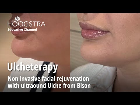 Ulchetherapy - Non invasive facial rejuvenation with ultraound Ulche ...