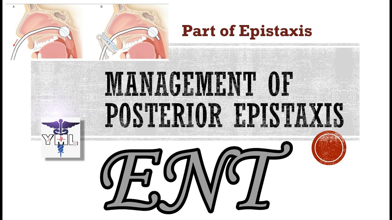 Management of Posterior Epistaxis — Part of Epistaxis - YouTube