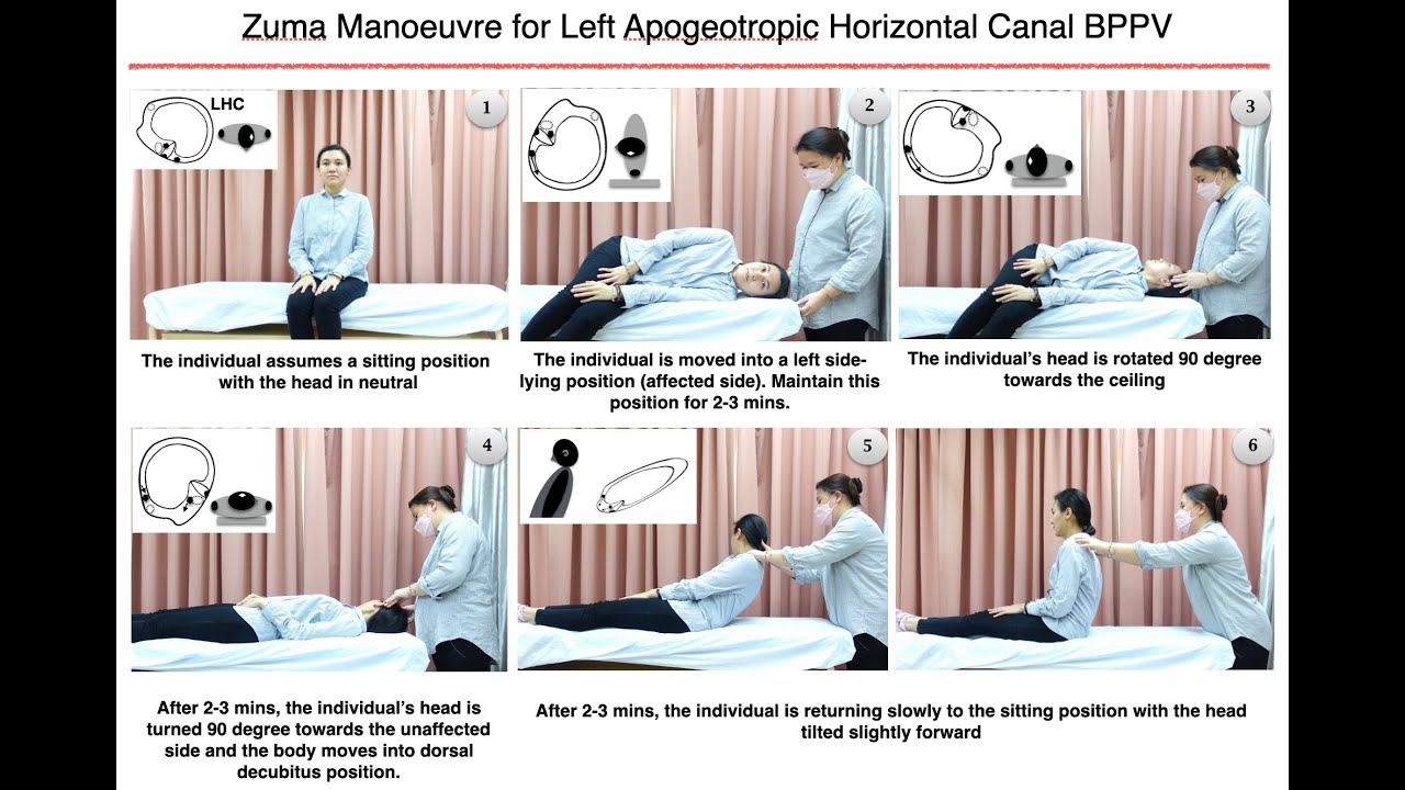 Zuma Manoeuvre for Left Apogeotropic Horizontal Canal BPPV - YouTube