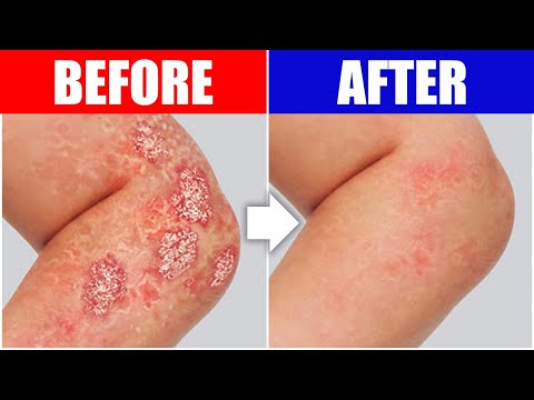 Psoriasis Relief: The Best Remedy For Your Skin