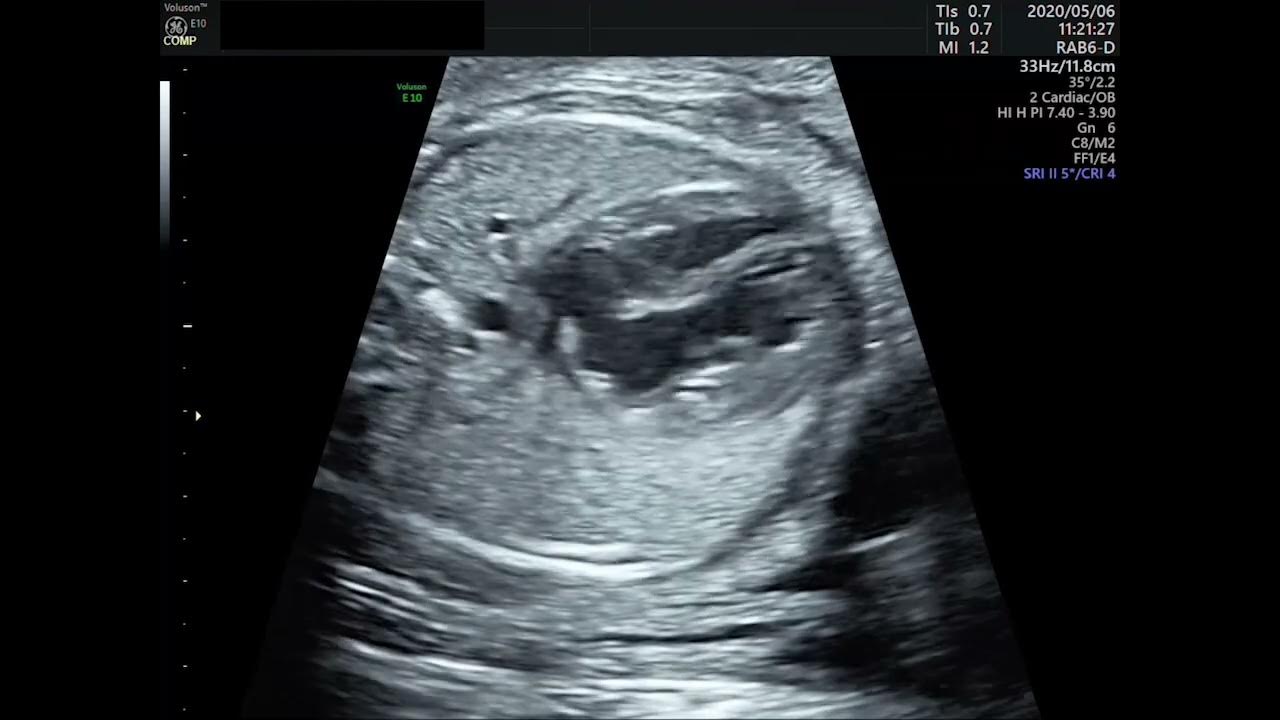 Asvide A Fetus With Redundant Foramen Ovale Flap And Suspected
