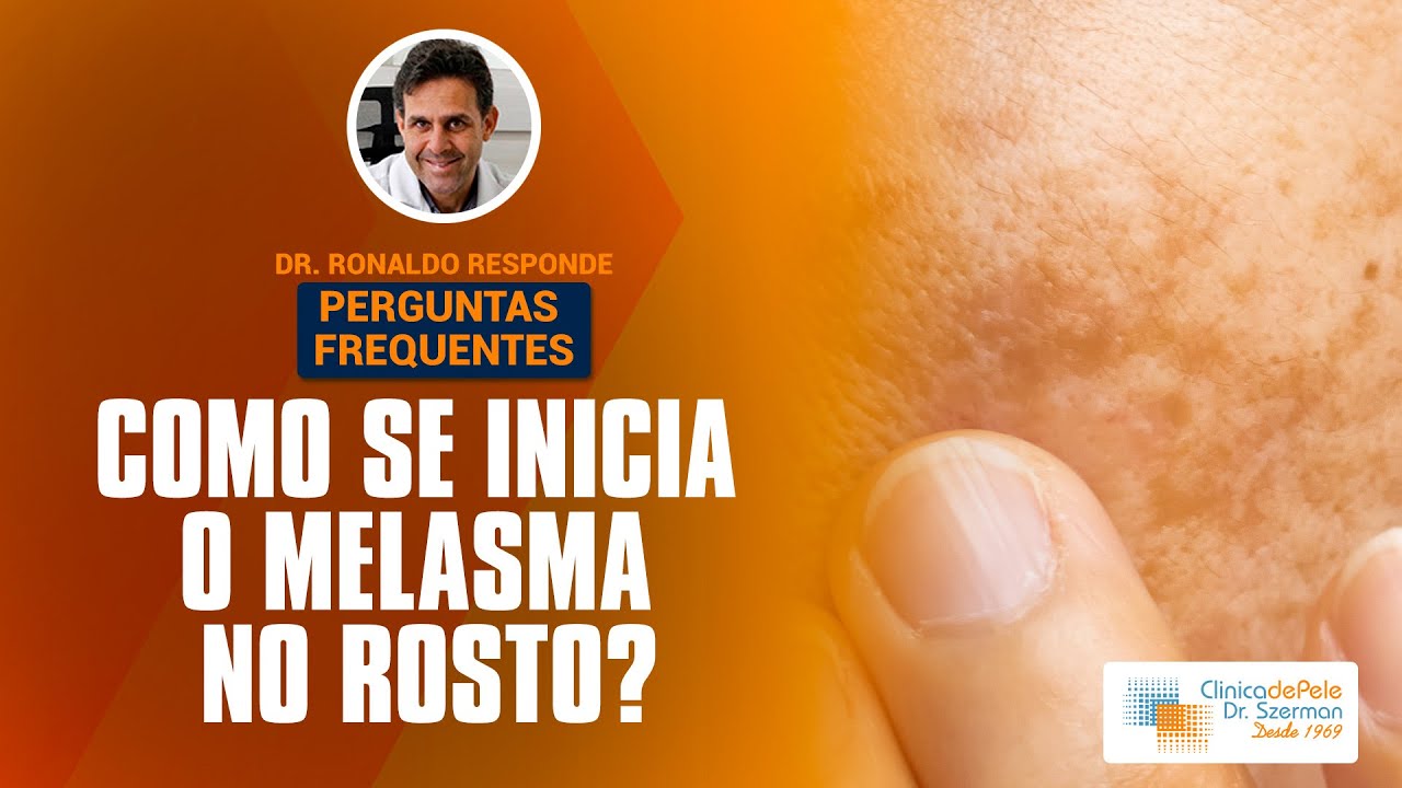 Como se inicia o Melasma no rosto? - YouTube