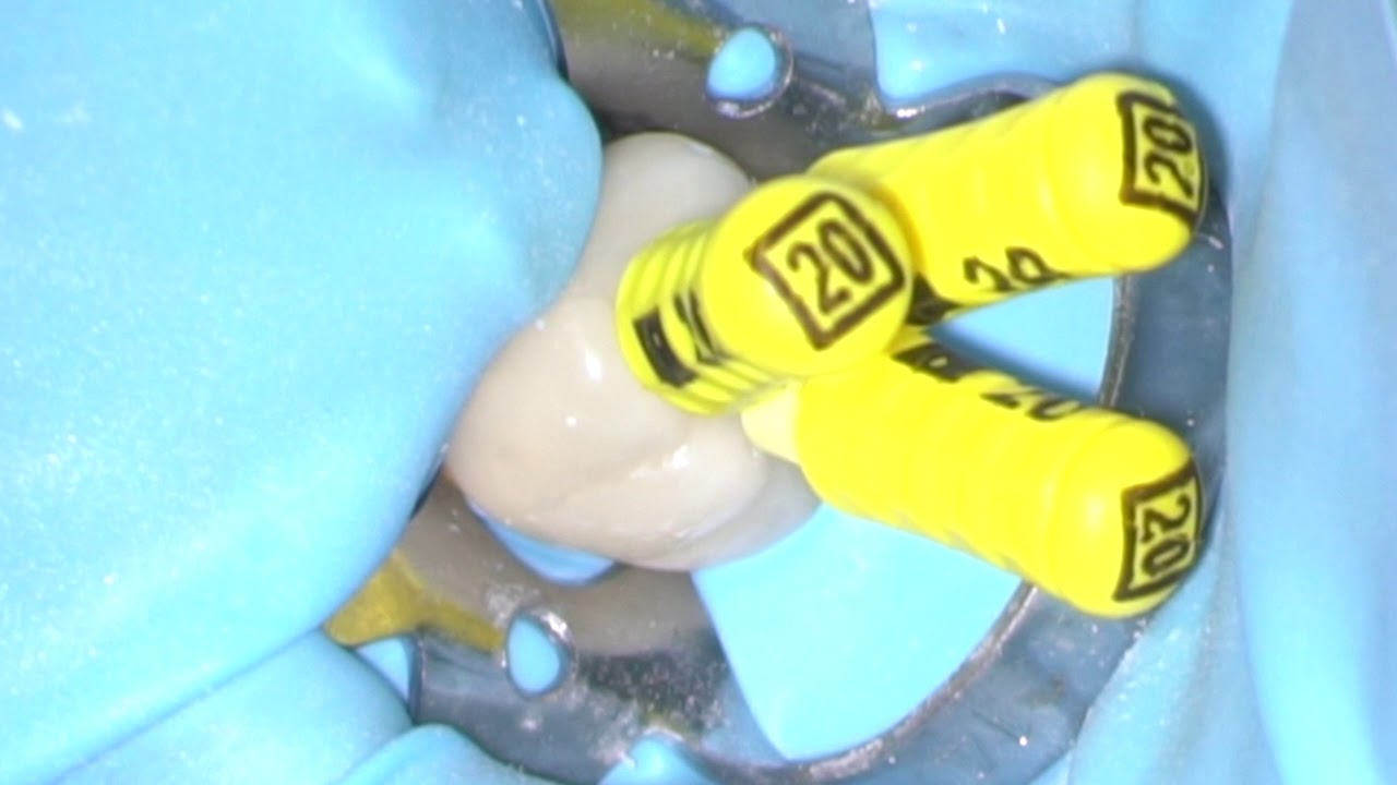 LL6 RCT through ceramic crown - YouTube