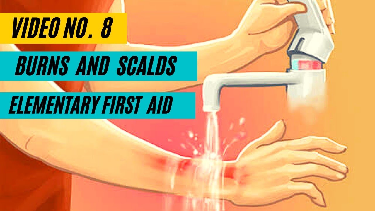 Burns and scalds - Elementary First Aid - YouTube