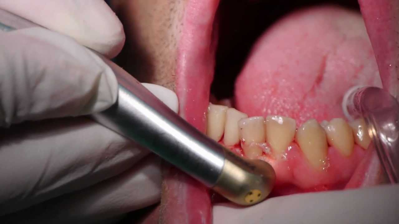 gingivectomia y gingivoplastia con laser.Dr joaquin garcía rodriguez ...
