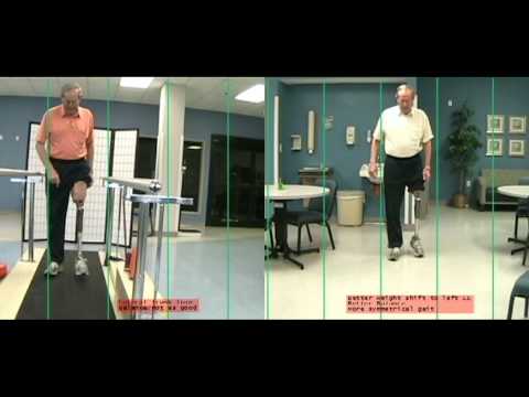 Video Analysis Amputee Gait - YouTube