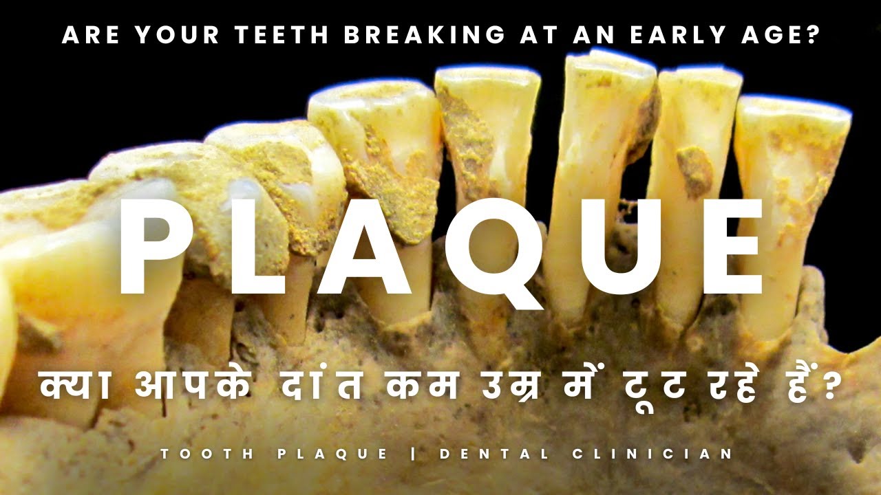 Are your teeth breaking at an Early Age? | Plaque Removal From Teeth ...