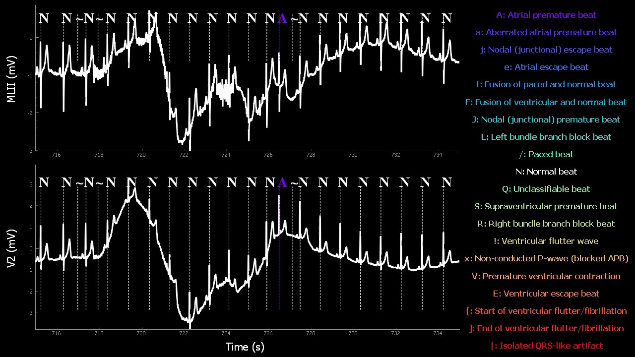 RealTime Electrocardiogram MIT-BIH Arrhythmia Database N°117 with tag ...
