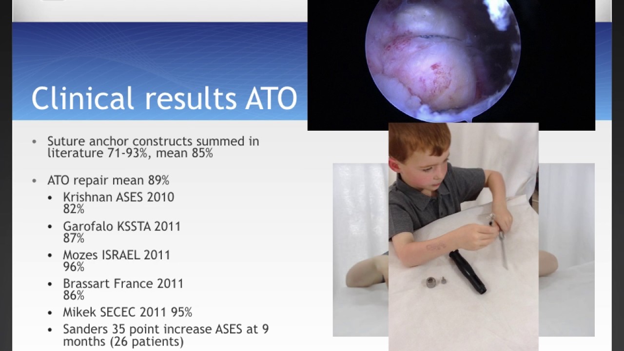 arthroscopic transosseous rotator cuff repair summary and technical ...