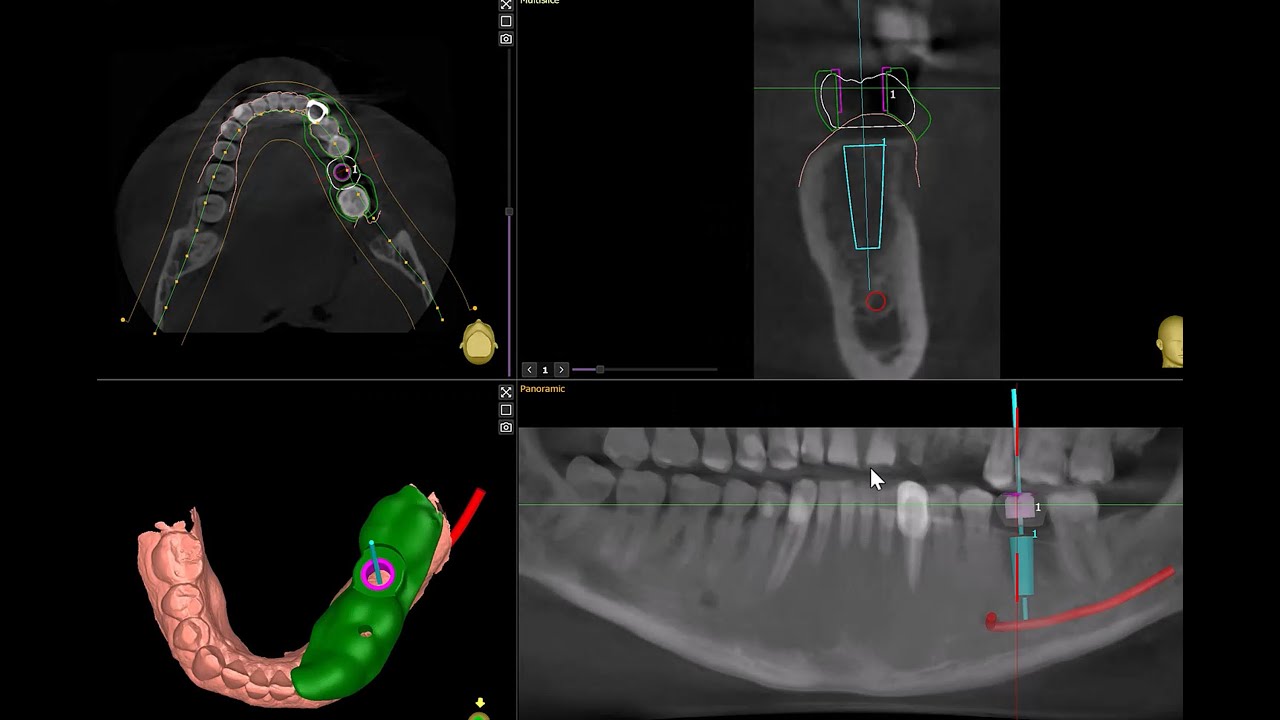Simple Implant surgical guide with Implastation software (Arabic ...